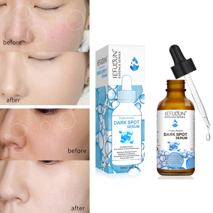 Dark Spot Correcting Whitening Freckle Facial Serum Powerful Removing Melasma Melanin Dark Spots ...