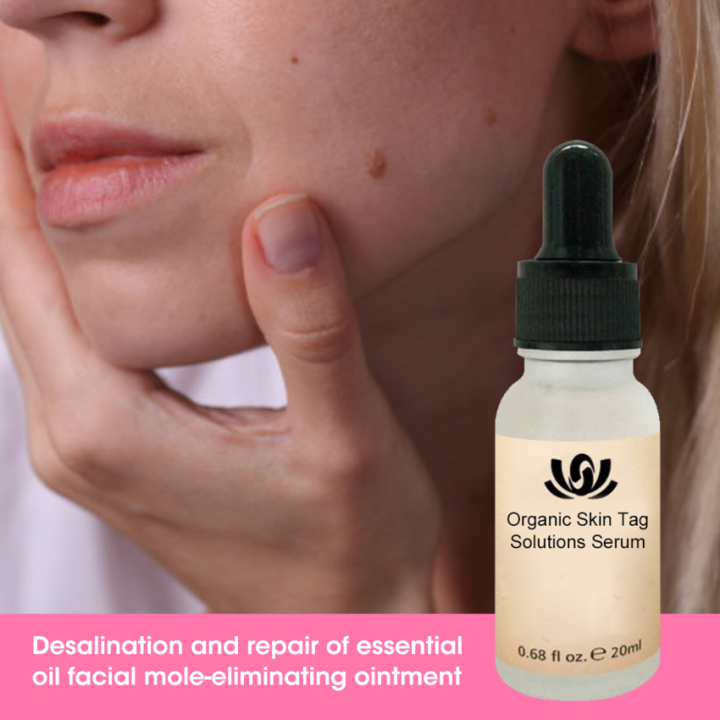Organic Tags Solutions Serum 30g No Trace Painle Skin Tag Remover Serum ...