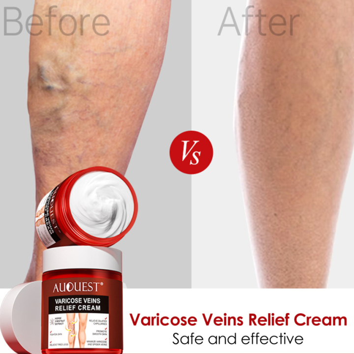 AUQUEST Varicose Veins Relief Cream Vasculitis Phlebitis Spider Pain ...