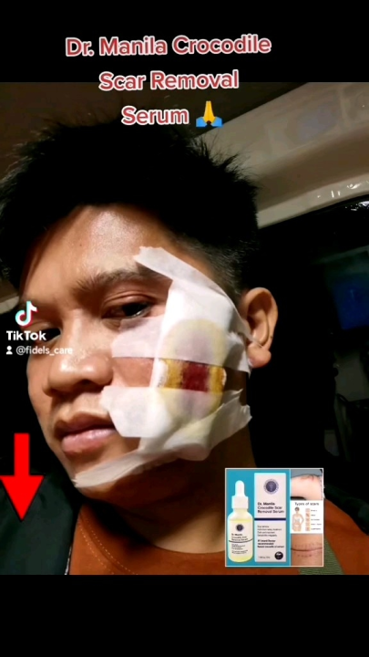 Dr. Manila Crocodile Scar Removal Serum (Original) | Lazada PH