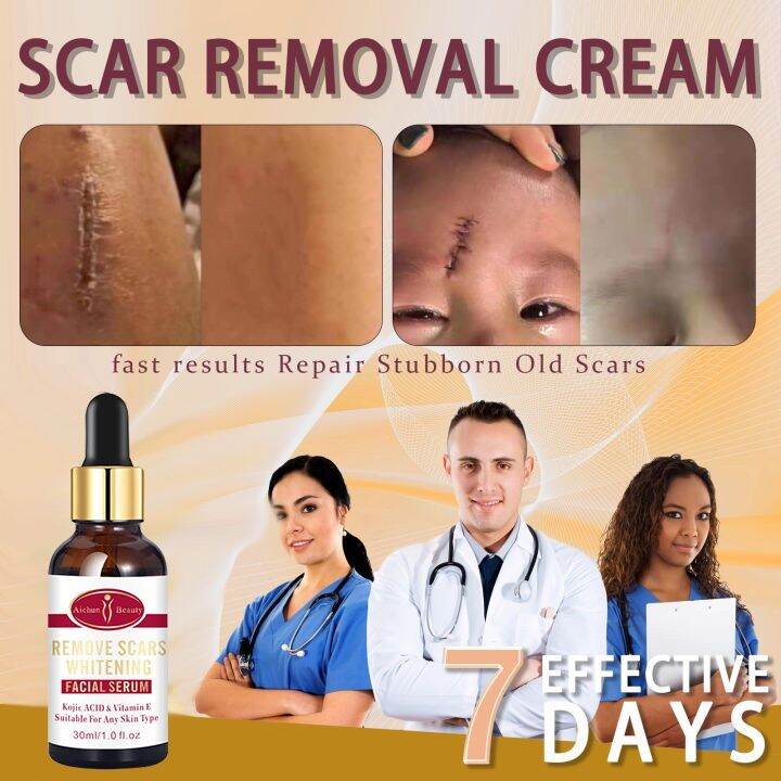Stretch marks remover acne scar remover gold old scars pimple treatment ...
