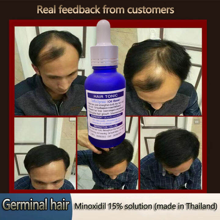 Minoxidil 15% ( BEST SELLING) (SEALED)Authentic Made in Thailand minimum price | Lazada PH