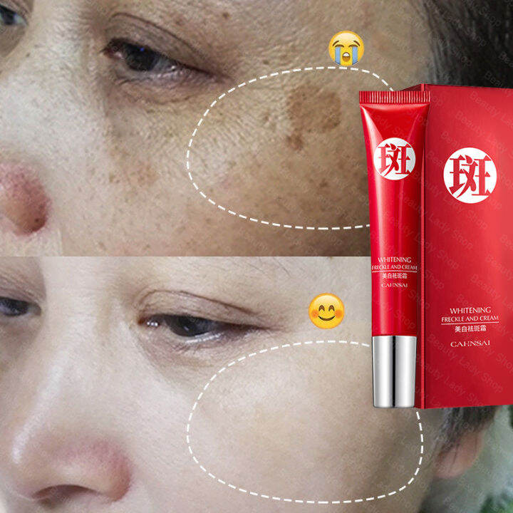 Original Pekas And Melasma Remover Pekas Remover Effective Whitening