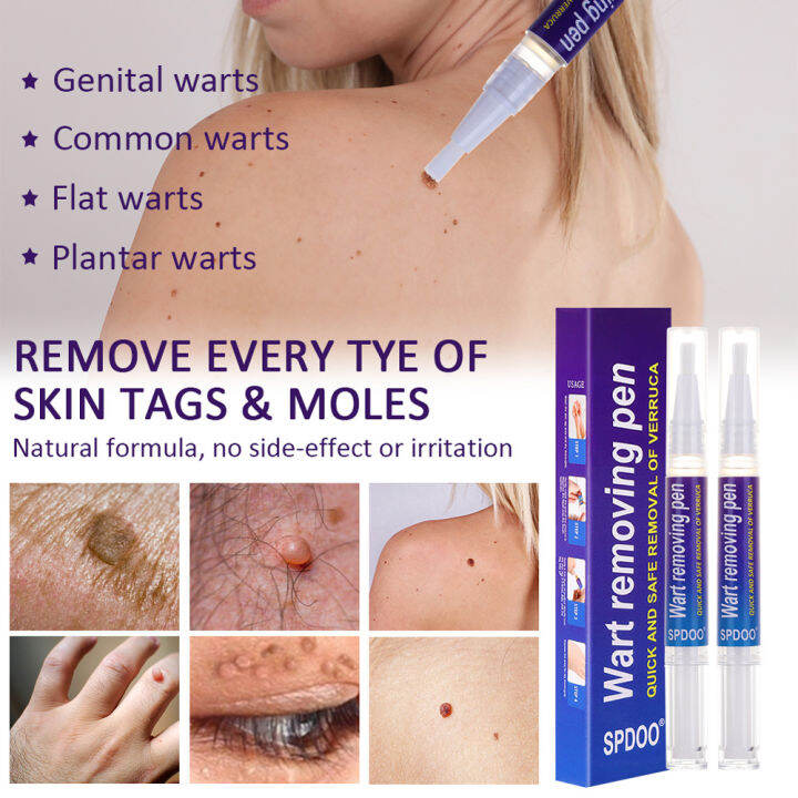 Skin Tag Remover Eliminate Warts Remover Cream Body Mole Wart Remover ...