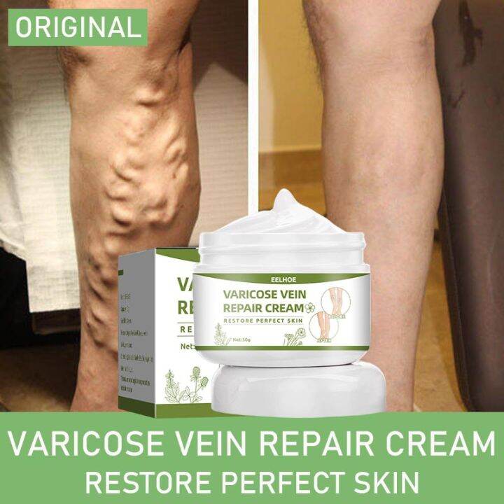ORIGINAL Varicose Vein Cream Spider Veins Phlebitis Swelling Pain ...