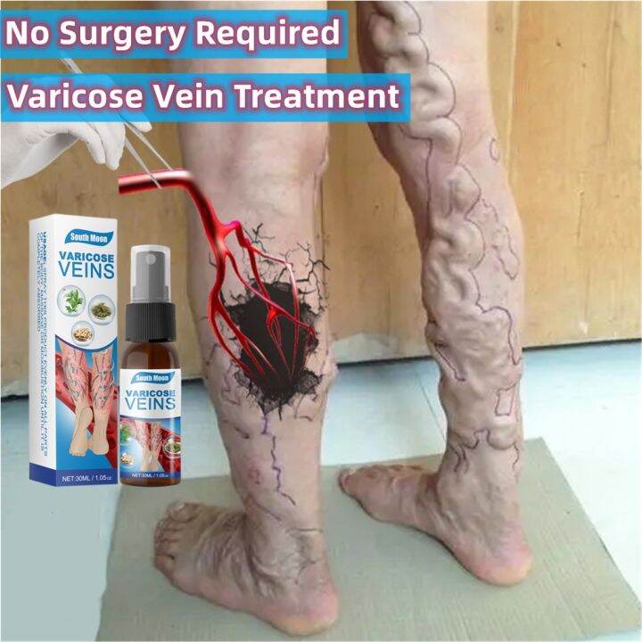 30ML【Hot Sale】South Moon Varicose Vein Soothing Spray varicose veins ...