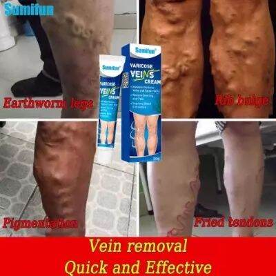 Sumifun Varicose Veins Cream Obat Varises Paling Ampuh Salep Penghilang ...
