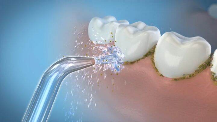 Waterpik® Classic Professional Water Flosser WP70E- เครื่องฉีดน้ำทำความ ...