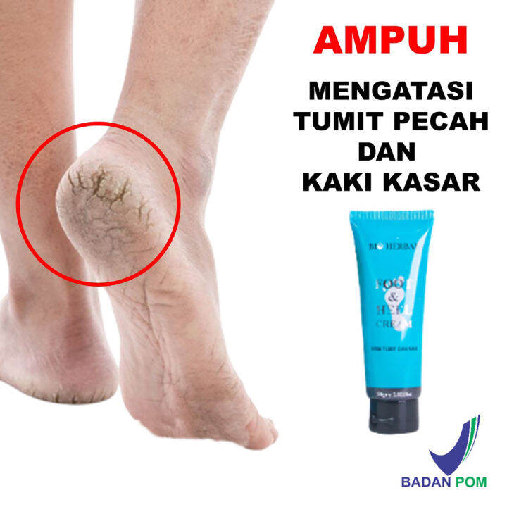Obat Kaki Pecah2 dan Kering Parah BPOM Mabrem Krim Kaki Salep ...