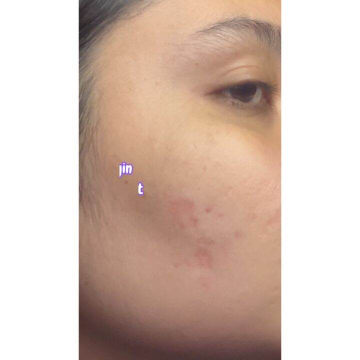 GLOW FX - Glow Bomb Serum - Serum Glowing & Bekas Jerawat 19% ...