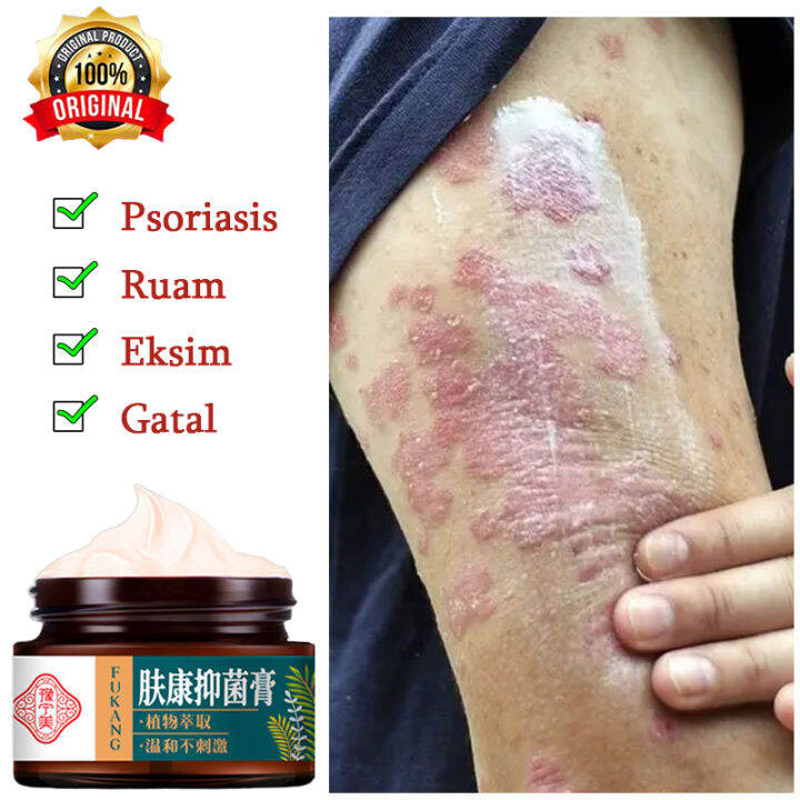 100% Effective Psoriasis Ointment Herbal Anti Itch Cream Psoriasis ...