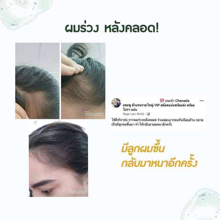 ส่งฟรี Chanada Shampoo แชมพูชะนะดะ (3 ชิ้น) แชมพูลดผมร่วง ฟื้นฟูรากผม ลดการอุดตันของรูขุมขน ...