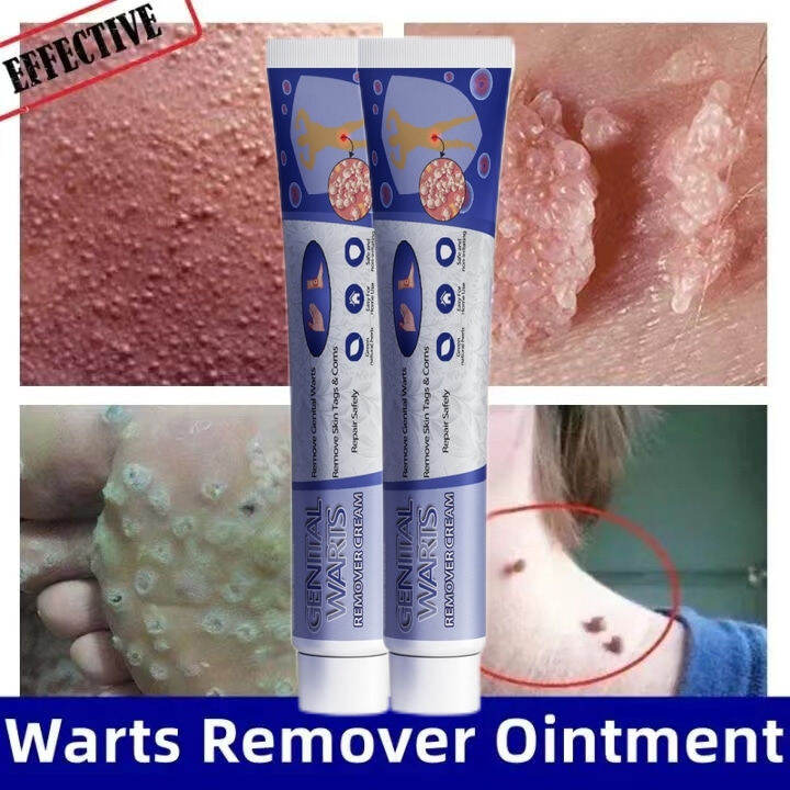 Warts Remover Cream Warts Magic Remover Wart Ointment Warts Remover ...