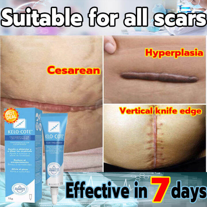 American original KELO-COTE scar remover for old scar on leg Peklat ...