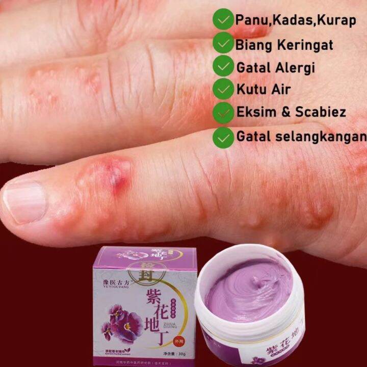 Eczema Ointment Itching Cream Antibacterial and antipruritic cream 30g ...