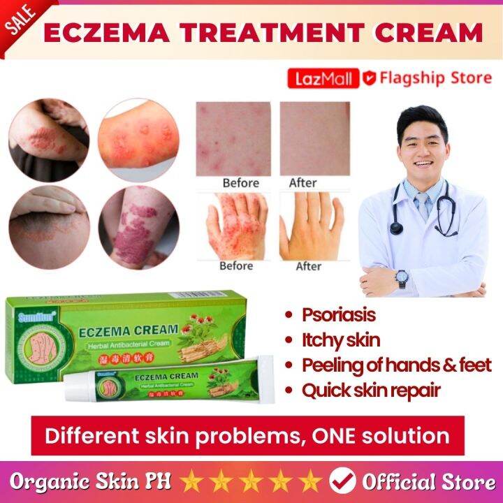 Eczema treatment cream solve skin problems like dermatitis, ringworm ...