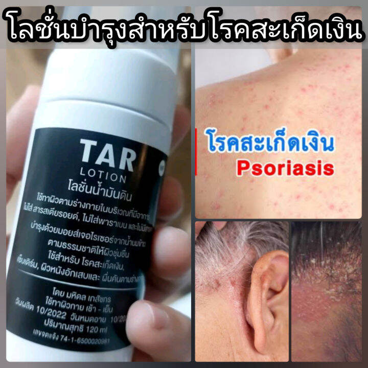 TAR LOTION ทาร์โลชั่น ช่วยเรื่องโรคสะเก็ดเงินเซบเดิร์ม , ผิวหนังอักเสบ ...