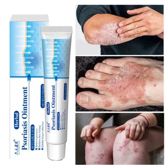 Psoriasis Antibacterial Ointment Topical Skin Ointment Inhibit Bacteria ...