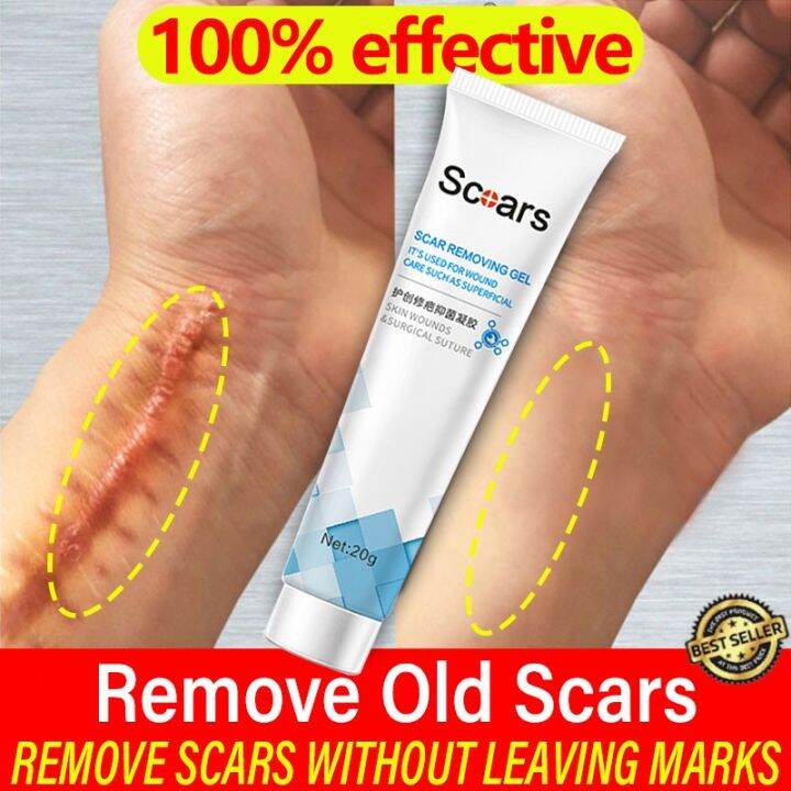 Old Scar Removal Cream Scar Removal Cream Peklat Remover Scar Gel Acne ...