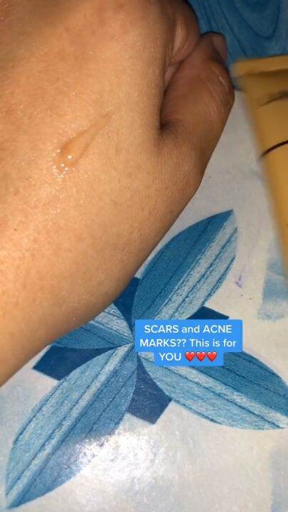 Original LANBENA TCM Scar AND Acne Removal Gel Ointment 30g Repairing ...