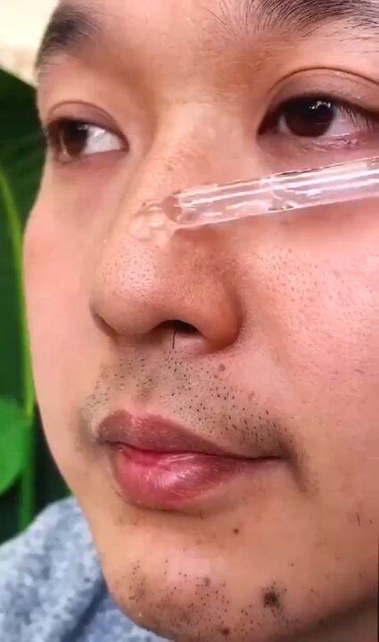 Melasma and pekas remover serum, dark spot remover for face melasma ...