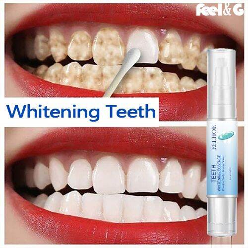 Teeth Whitening Pen Yellow Teeth Cavities Plaque Elimination Instant ...