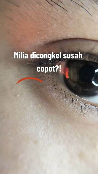 PAKET KHUSUS MILIA SYRINGOMA !! Paket 2in1 milia syringoma Cream ...