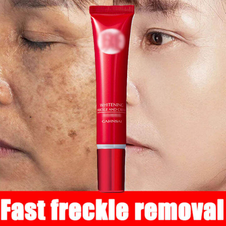 20g Melasma Remover Cream Remove Dark Spot Remover Anti Aging Facial ...