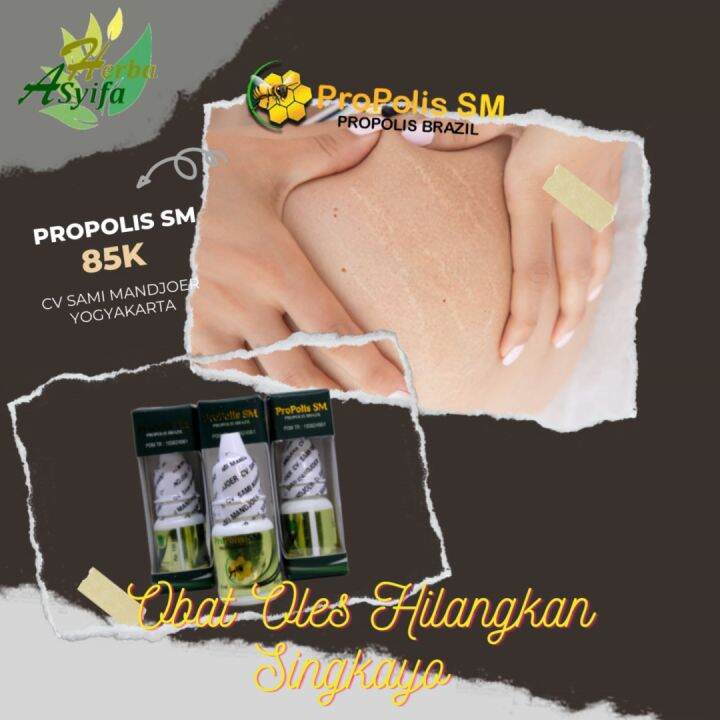 Obat Oles Hilangkan Singkayo - garis berwarna putih di paha ...