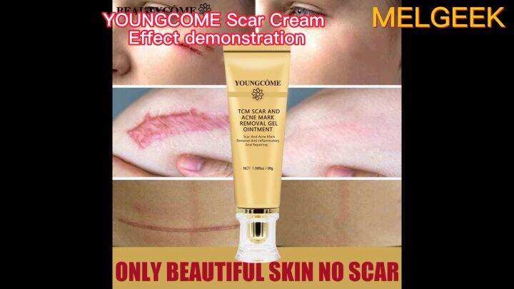 👍 True And Effective Scar Remover For Old Scar On Leg Remove Scars