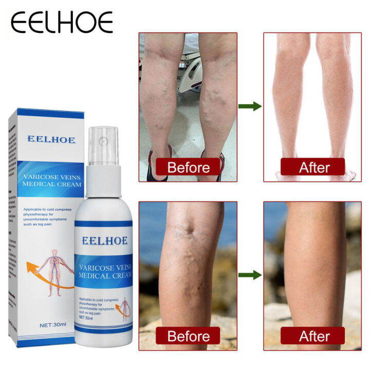 Eelhoe Varicose Vein Soothing Spray Vasculitis Phlebitis Spider Leg ...