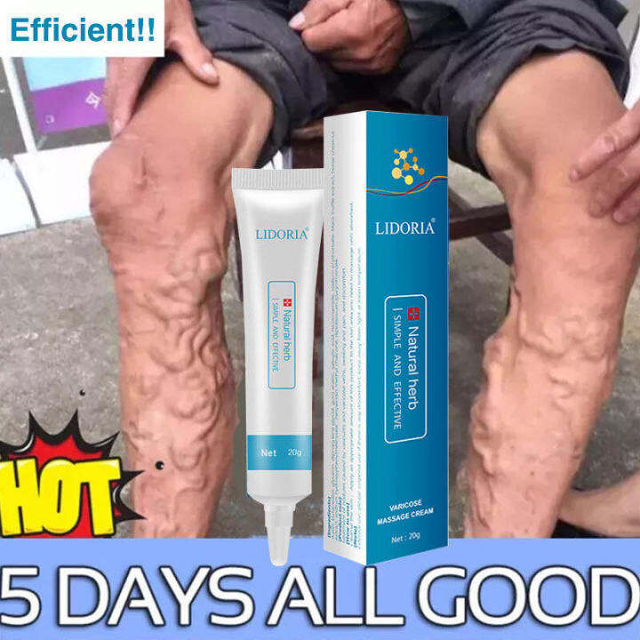 Varicose Veins Cream Effective Vasculitis Phlebitis Remover Spider ...
