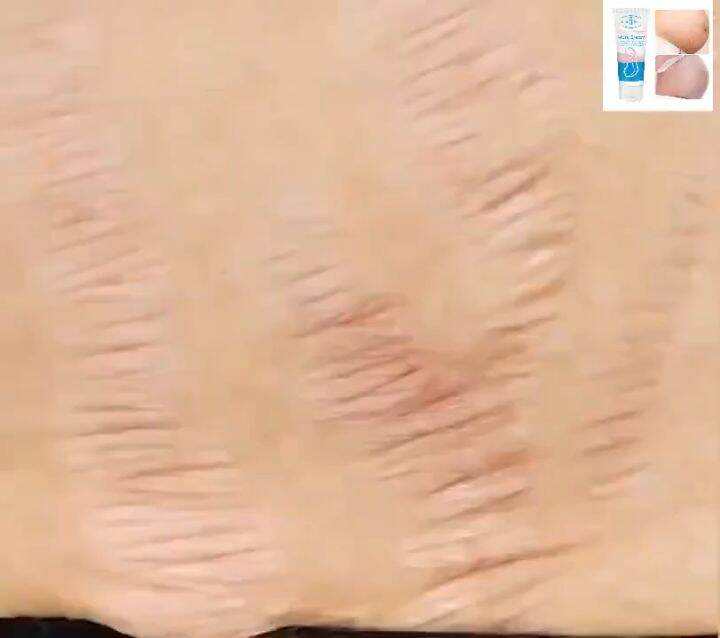 CICI MART Aichun Beauty stretch Mark Cream Dark Spot Remover ...