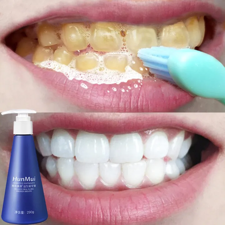 hunmui probiotic toothpaste menyingkirkan karang gigi 290g avecmoi ...
