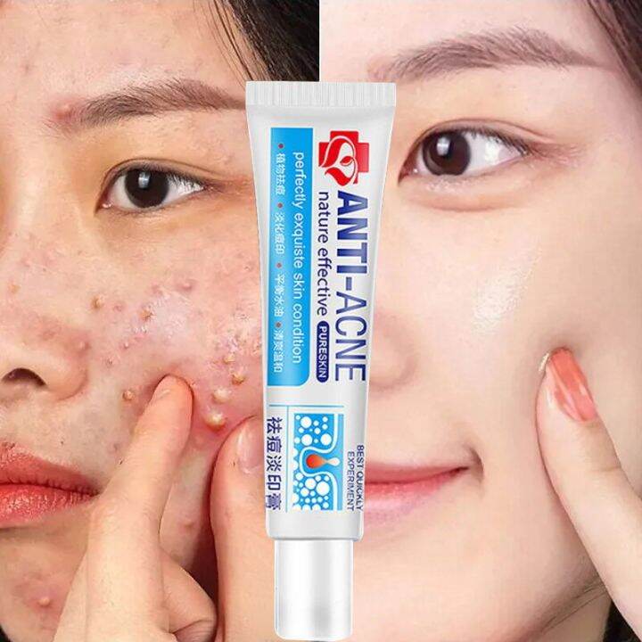 100% Effective Remove Pimples Quickly Pimple Remover Acne Cream Fades Acne Marks Repairs Acne ...