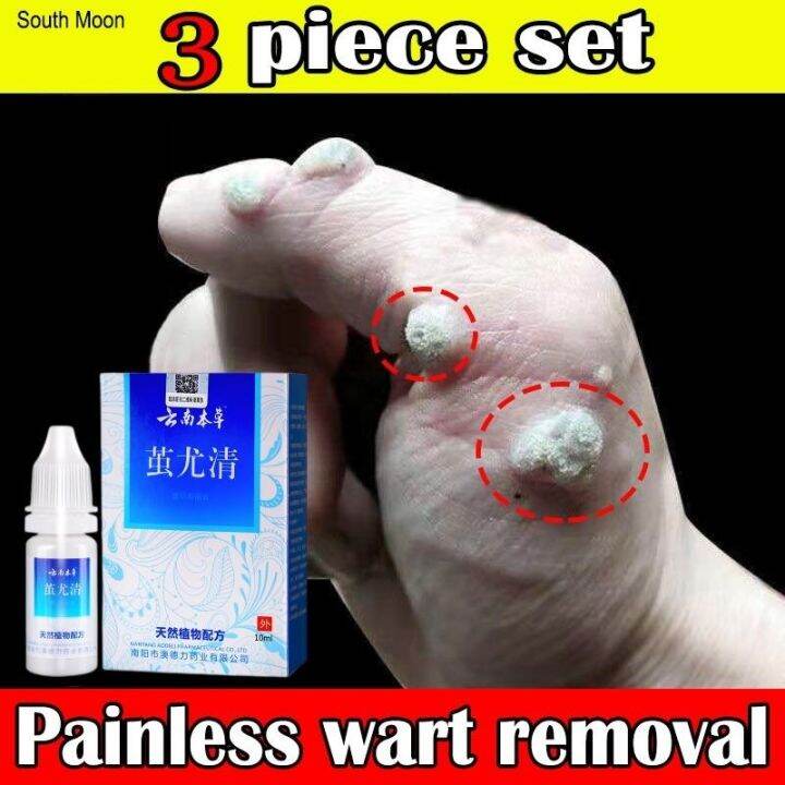 Wart Remover Cream Tag Solution Skin Tag Mole Buang Tahi Lalat Ketuat ...