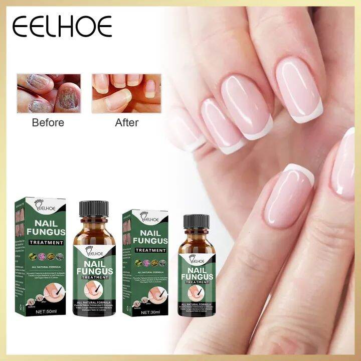 Eelhoe Nail Fungus Treatment nail treatment care fungal nail treatment ...