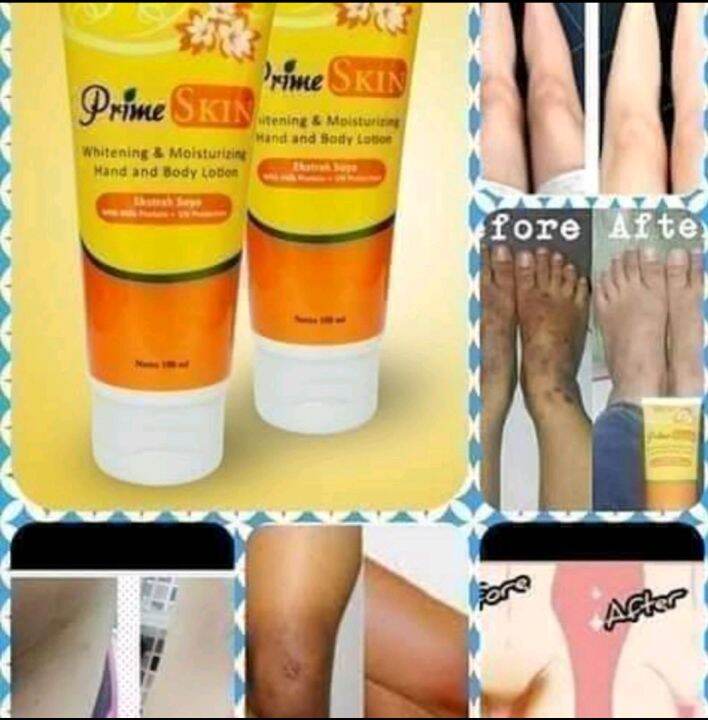 Prime skin body lotion,mengatasi bekas gigitan nyamuk,bekas luka ...