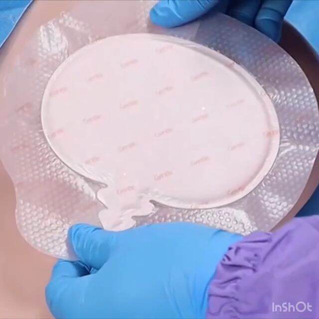 แผลกดทับ ชนิดแผ่นเล็ก 17x17cm. แผ่นแปะสำหรับก้นกบและบริเวณทั่วไป ยี่ห้อ ...