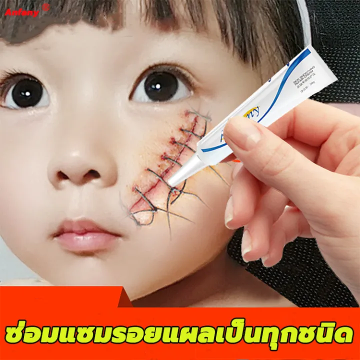 Anfany ครีมลดรอยแผลเป็น 30g ลดรอยเเผลเป็น กำกัดแผลเป็นทุกชนิด ได้อย่างมี ซ่อมแซมรอยแผลต่างๆ ลด ...