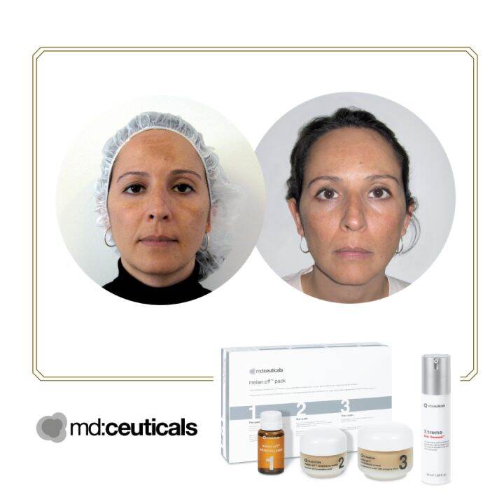 md ceuticals Melan: Off Depigmentation Treatment Bộ sản phẩm giảm nám ...