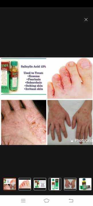 Zema Lotion Dermatitis Original Thailand ( 2 pcs ) | Lazada