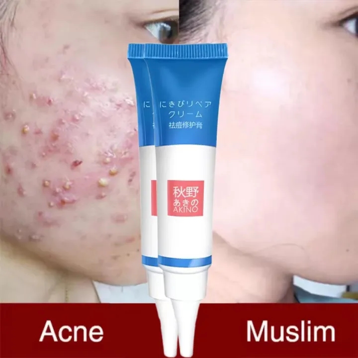 Remove Pimples Quickly Acne gel scar remover Pimple Remover Acne Cream Fades Acne Marks Repairs ...