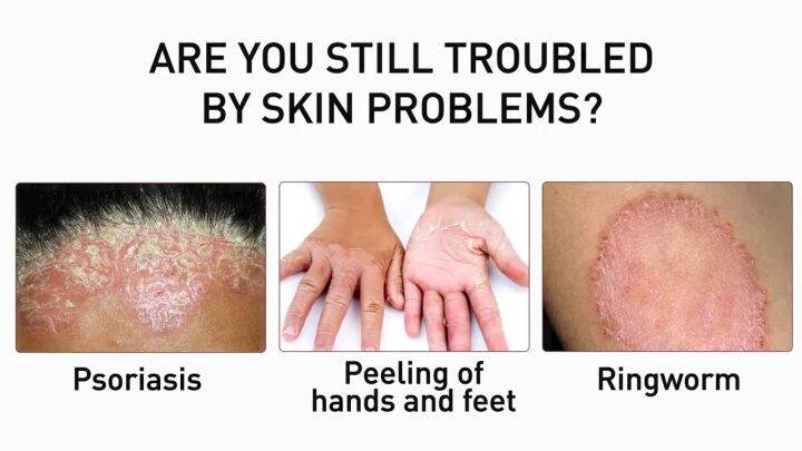 Eczema cream itching cream antibacterial cream private parts itching ...