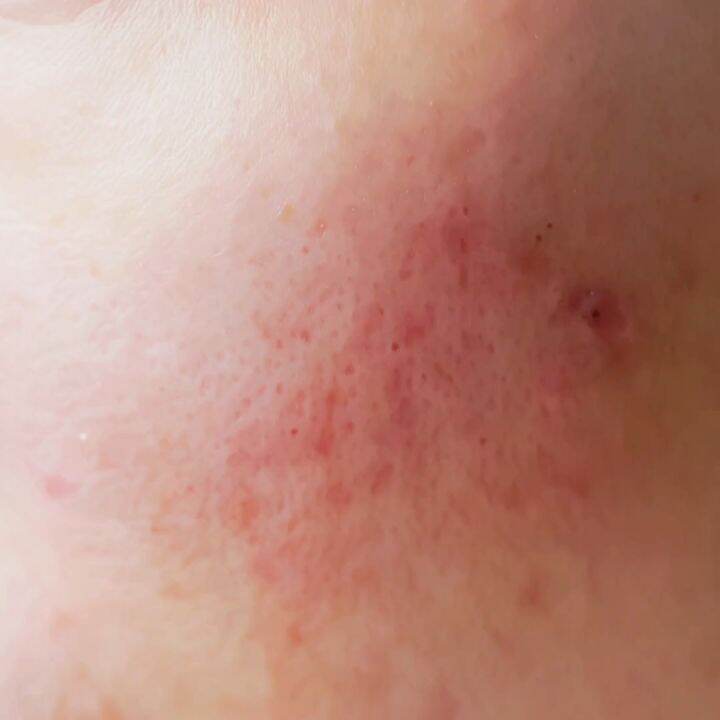 PekasCare 50 mL For Men and Woman Pekas Remover Age Spots, Acne Spots ...