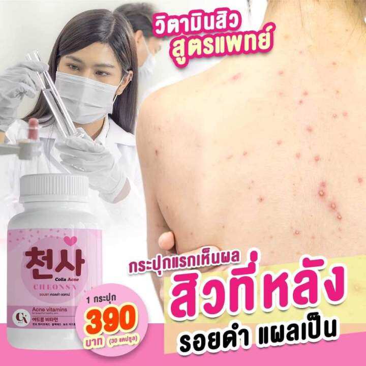 Cheonsa ลดสิวที่ต้นเหตุ นวัตกรรมใหม่เห็นผลไวกว่าวิตามินสิวทั่วไป 🔥เซ็ต ...
