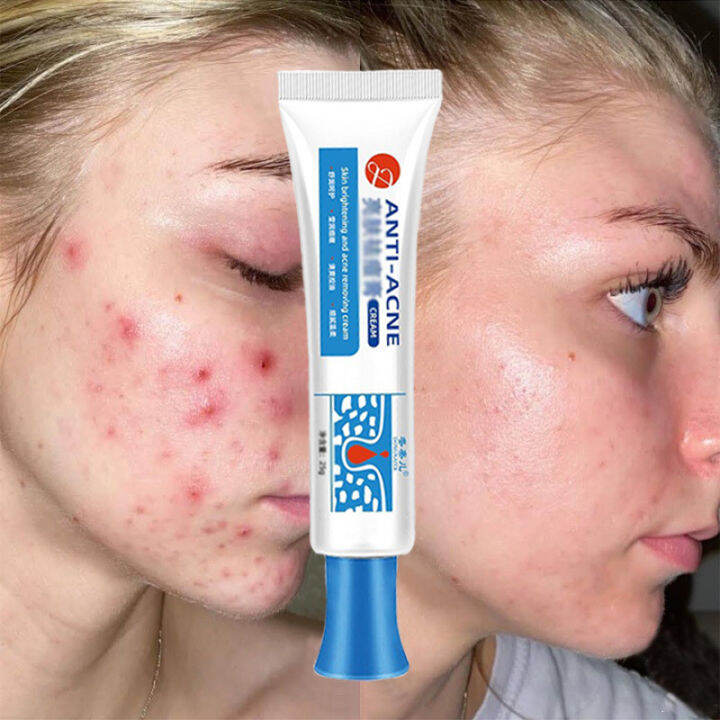 Remove Pimples Quickly Pimple Remover Acne Cream Fades Acne Marks Repairs Acne Pits Facial Scar ...