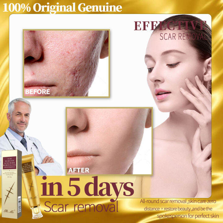 Keloids Scar Remover For Old Scar On Leg Fix Scar Removal Cream