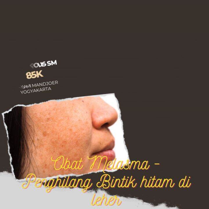 Obat Melasma - Penghilang Bintik hitam di leher - bercak hitam di wajah ...