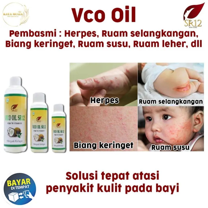 SR12 - Obat Kulit bayi / obat ruam popok bayi / obat ruam pipi / obat ...